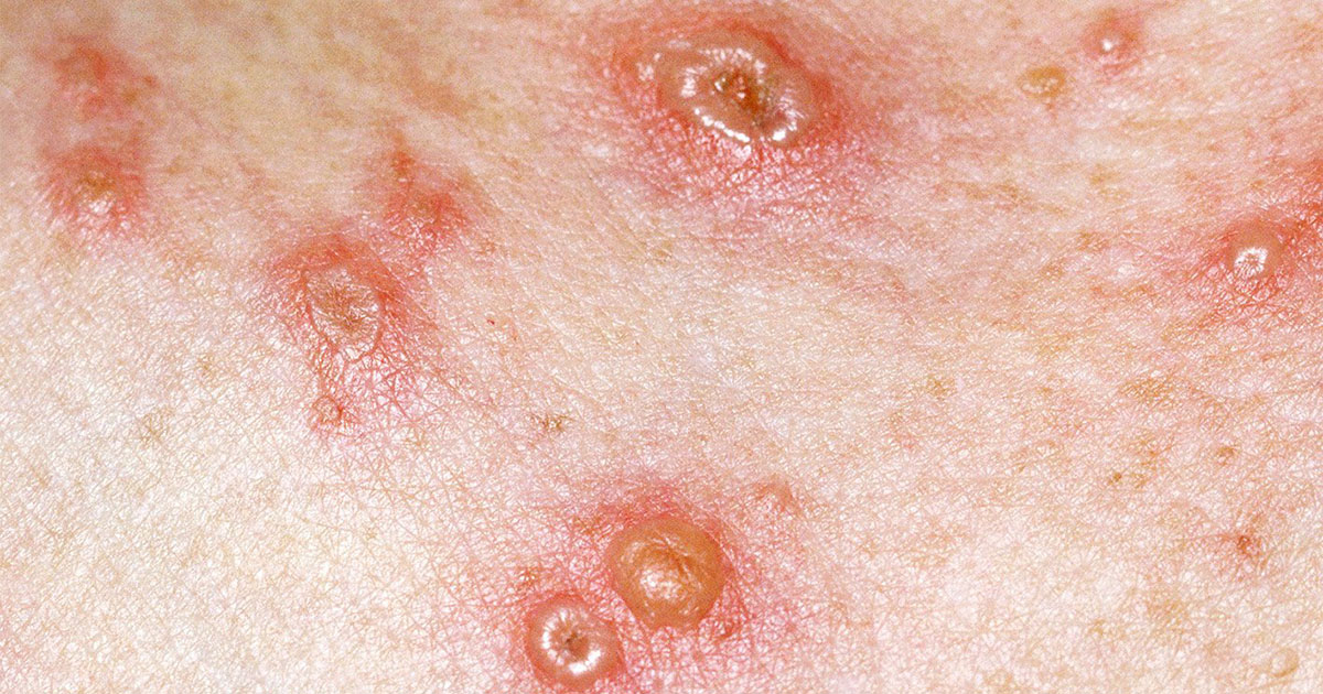 Chicken Pox Rash